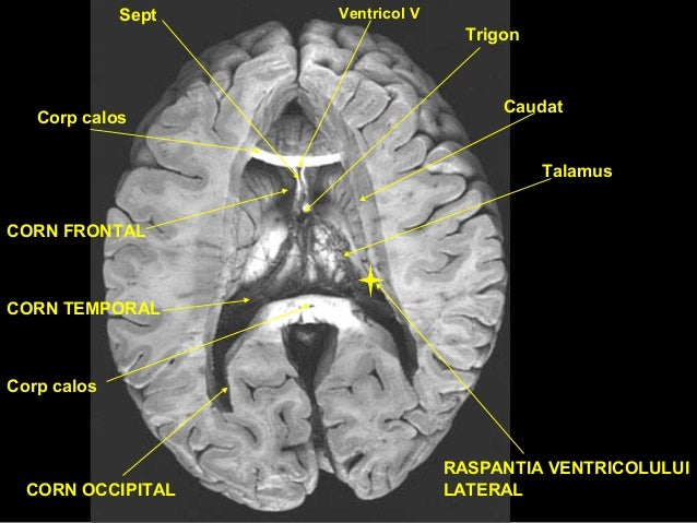 Atlas de neuroanatomie - Ventriculi cerebrali