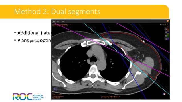 Optimising breast dosimetry: Improving homogeneity through the ...
