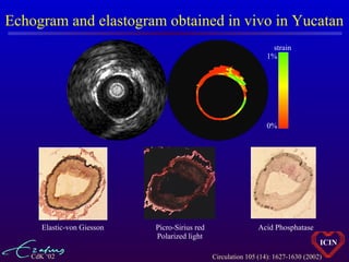Elastography | PPT | Heart and Cardiovascular Diseases | Diseases and ...