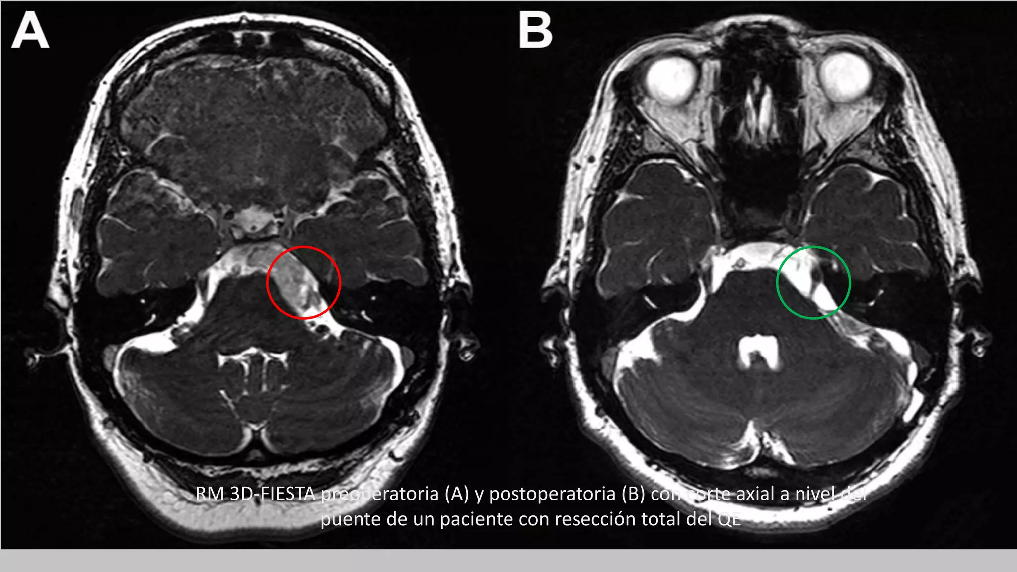Quiste epidermoide de fosa posterior serie de casos SCNO A2022 0715 | PPT