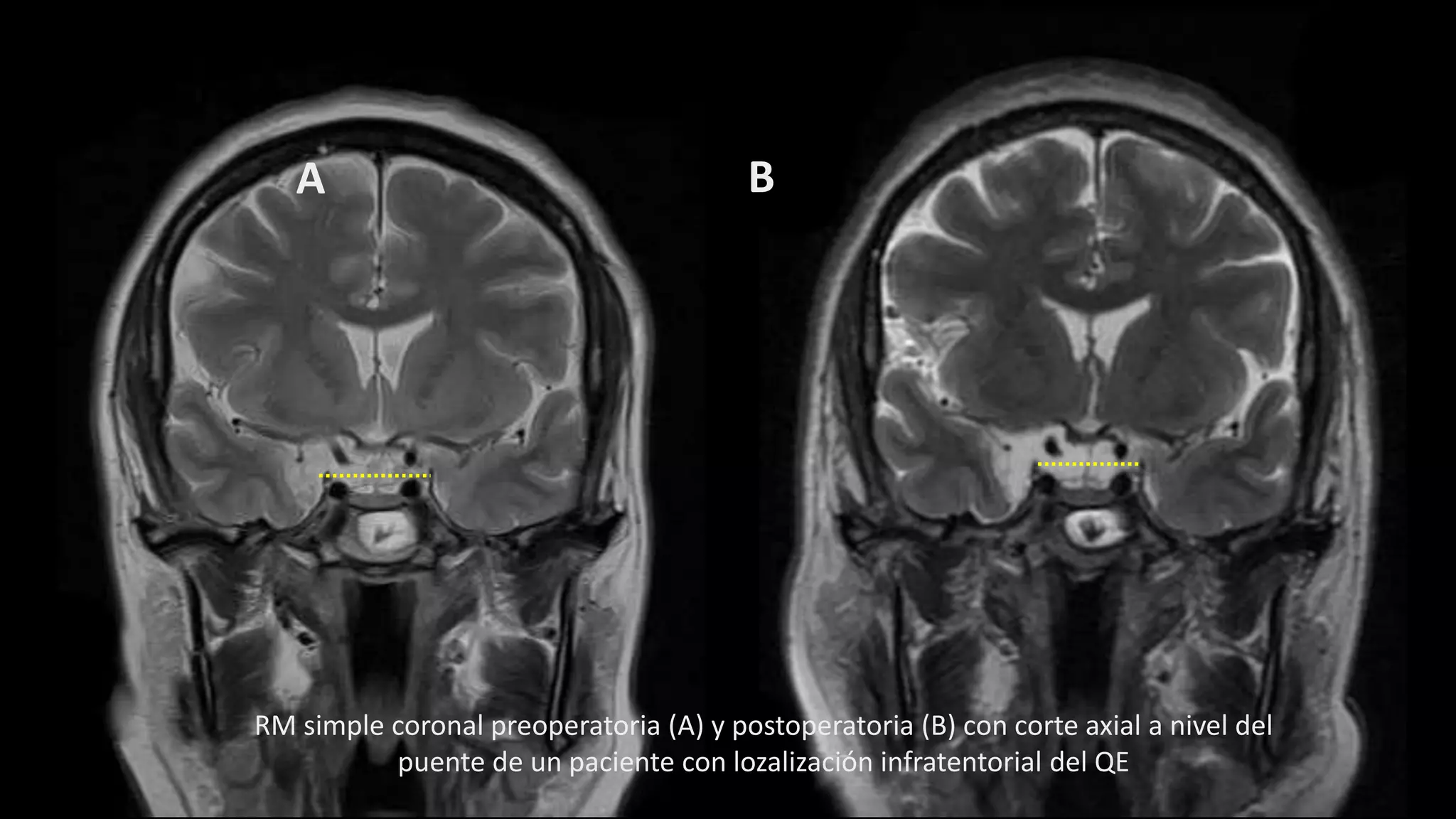 Quiste epidermoide de fosa posterior serie de casos SCNO A2022 0715 | PPT
