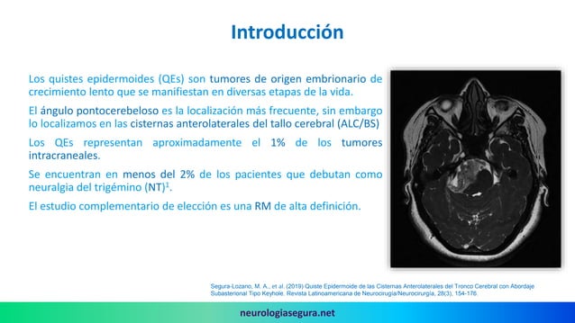 Quiste epidermoide de fosa posterior serie de casos SCNO A2022 0715 | PPT