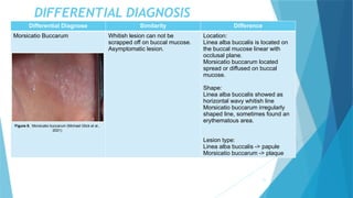 Ilmu Penyakit Mulut Tingkat Lanjut - Klinik PPDGS IPM UNAIR 2024 Linea Alba Buccalis.pptx