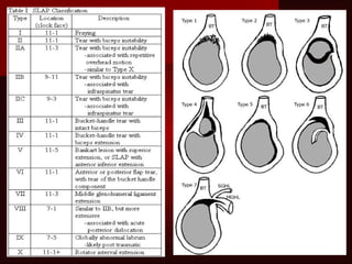 Biceps tendon pathology | PPT
