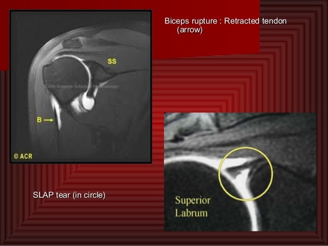 Biceps tendon pathology