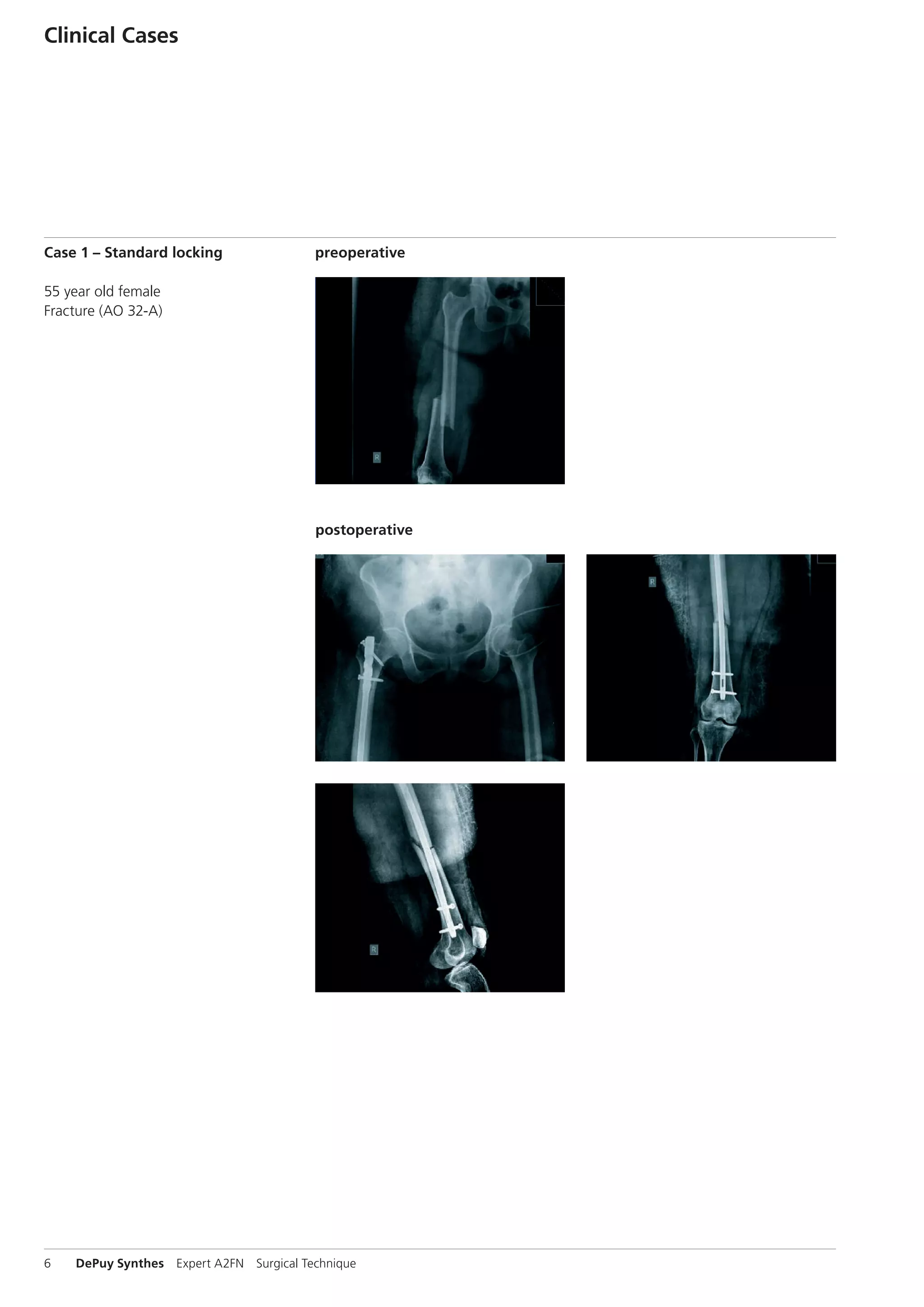 A2FN Synthes dsem trm-1015-0537-1-lr | PDF