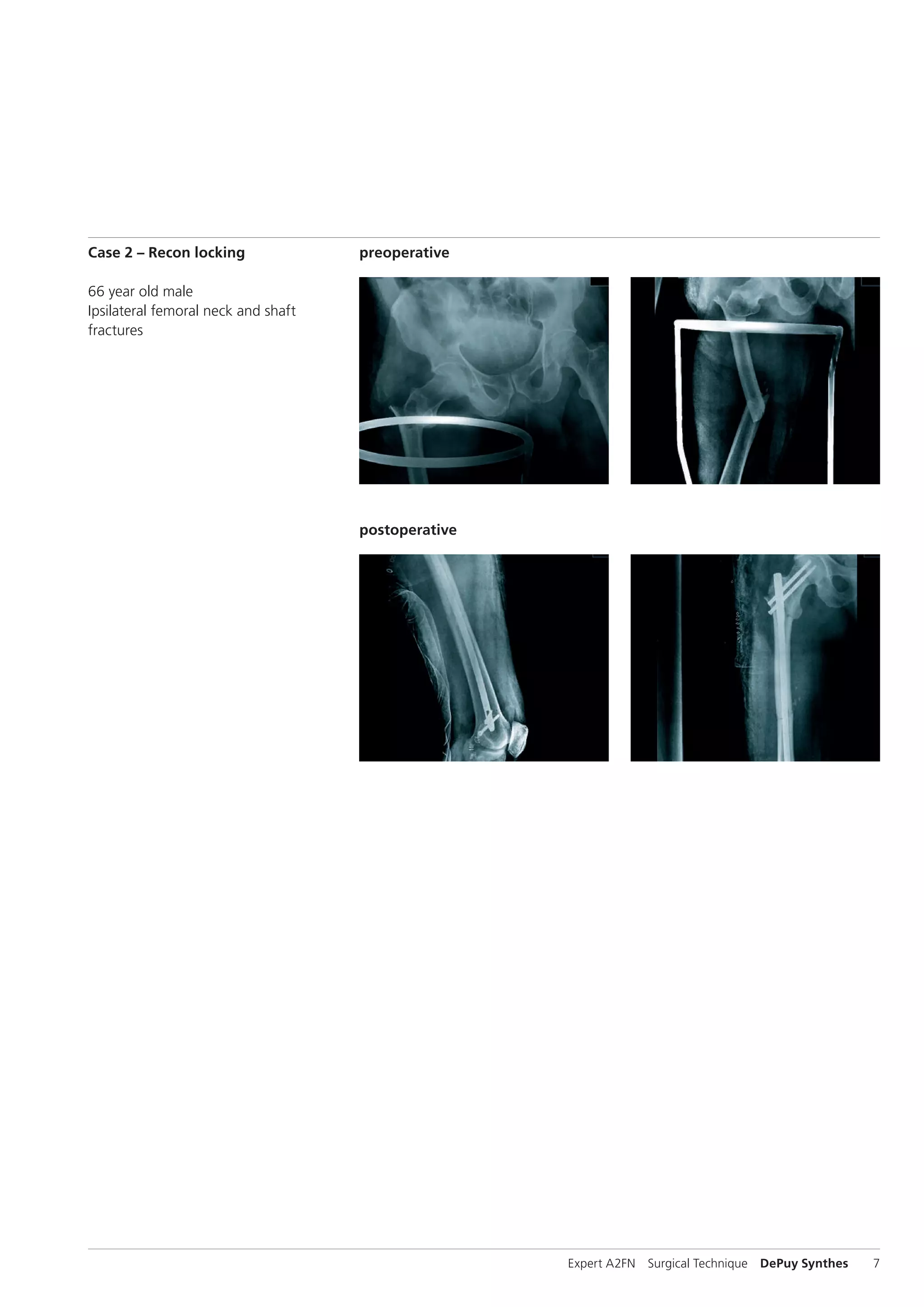 A2FN Synthes dsem trm-1015-0537-1-lr | PDF