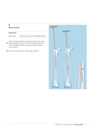 A2FN Synthes dsem trm-1015-0537-1-lr | PDF