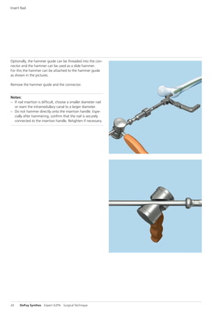 A2FN Synthes dsem trm-1015-0537-1-lr | PDF