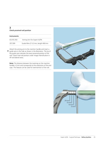 A2FN Synthes dsem trm-1015-0537-1-lr | PDF