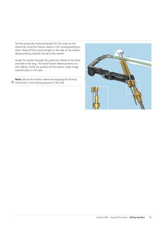 A2FN Synthes dsem trm-1015-0537-1-lr | PDF