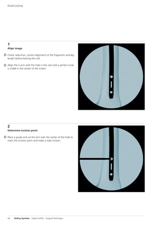 A2FN Synthes dsem trm-1015-0537-1-lr | PDF