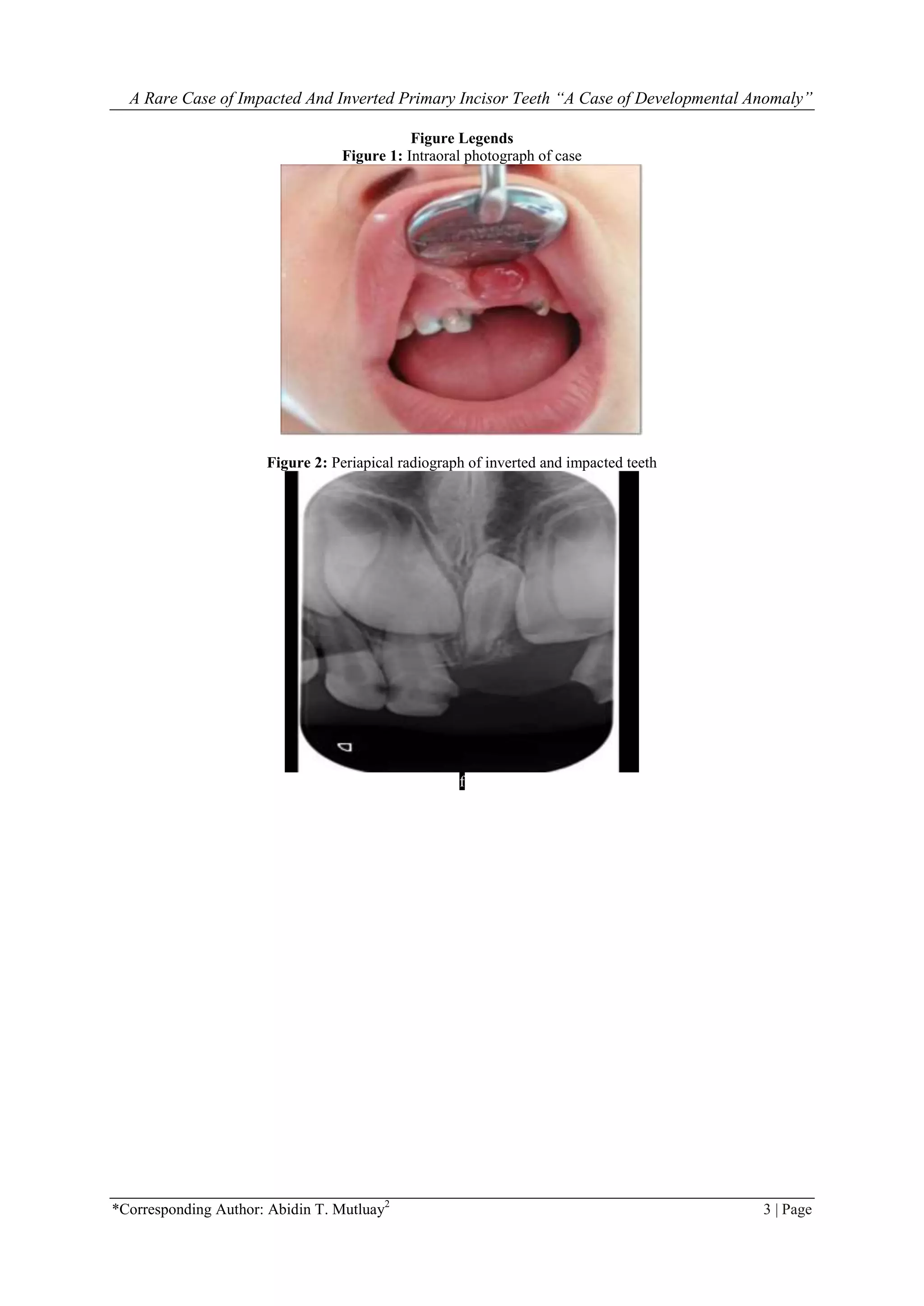 A Rare Case of Impacted and Inverted Primary Incisor Tooth “A Case of ...