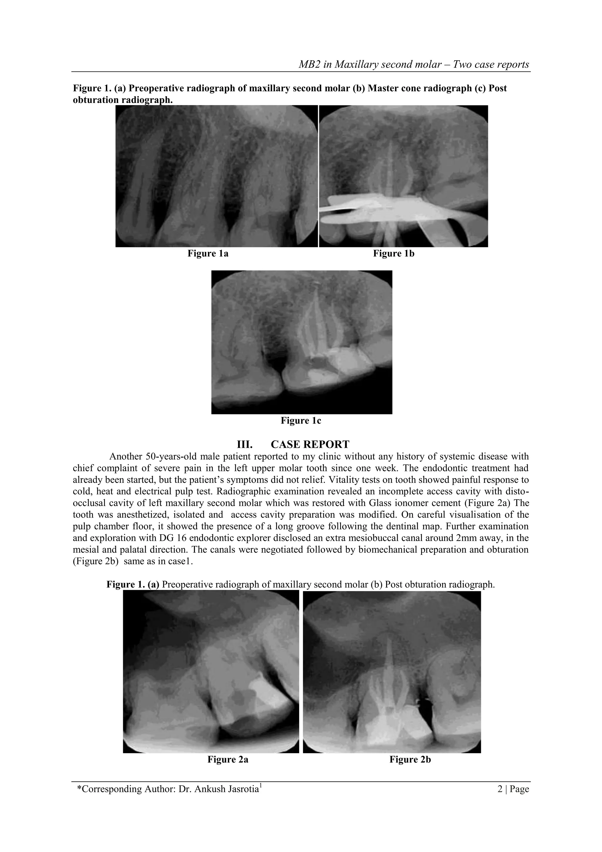 MB2 In Maxillary Second Molar – Two Case Reports | PDF