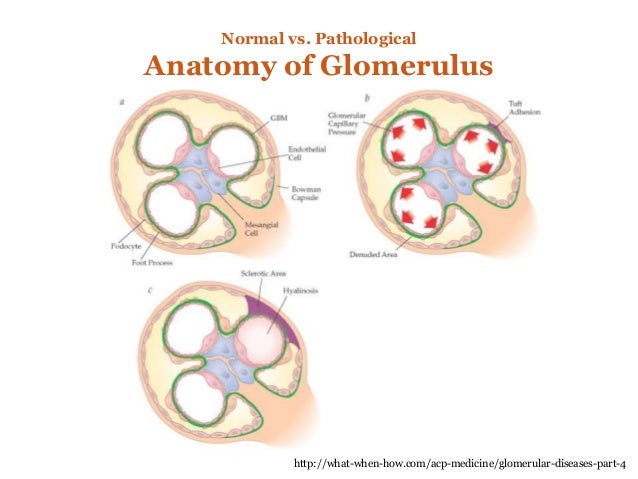 Focal Segmental Glomerulosclerosis (FSGS)