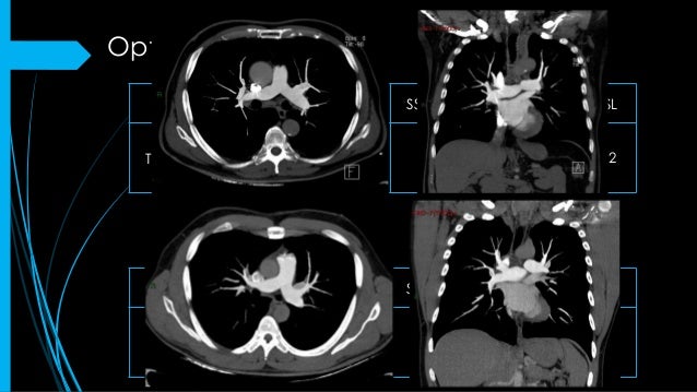 Angio tc de torax por diagnostico de TEP, justiicacion y su impacto e…