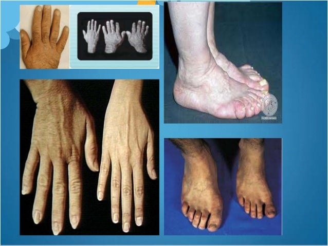 Acromegaly Symptoms Diagnosis Treatment Patient Resources
