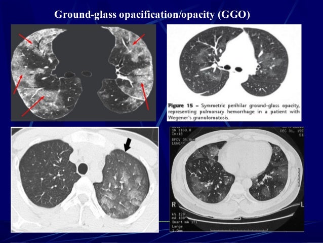 HRCT High attenuation pattern