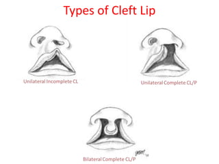 cleft l&p ENGLISH VERSION FOR PRESENTATION FOR ICN + AN | PPT