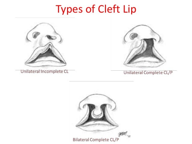 cleft l&p ENGLISH VERSION FOR PRESENTATION FOR ICN + AN