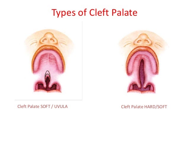 cleft l&p ENGLISH VERSION FOR PRESENTATION FOR ICN + AN