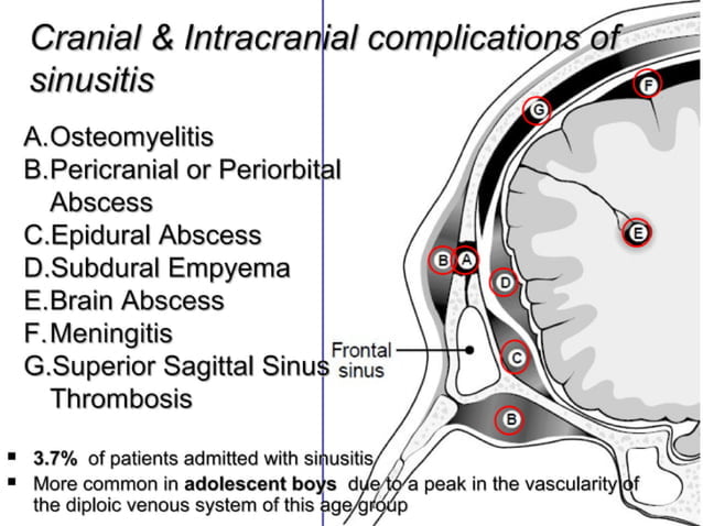 sinusitis rhinoghjvhjvjghgmhgvhhvghvhvhjv | PDF