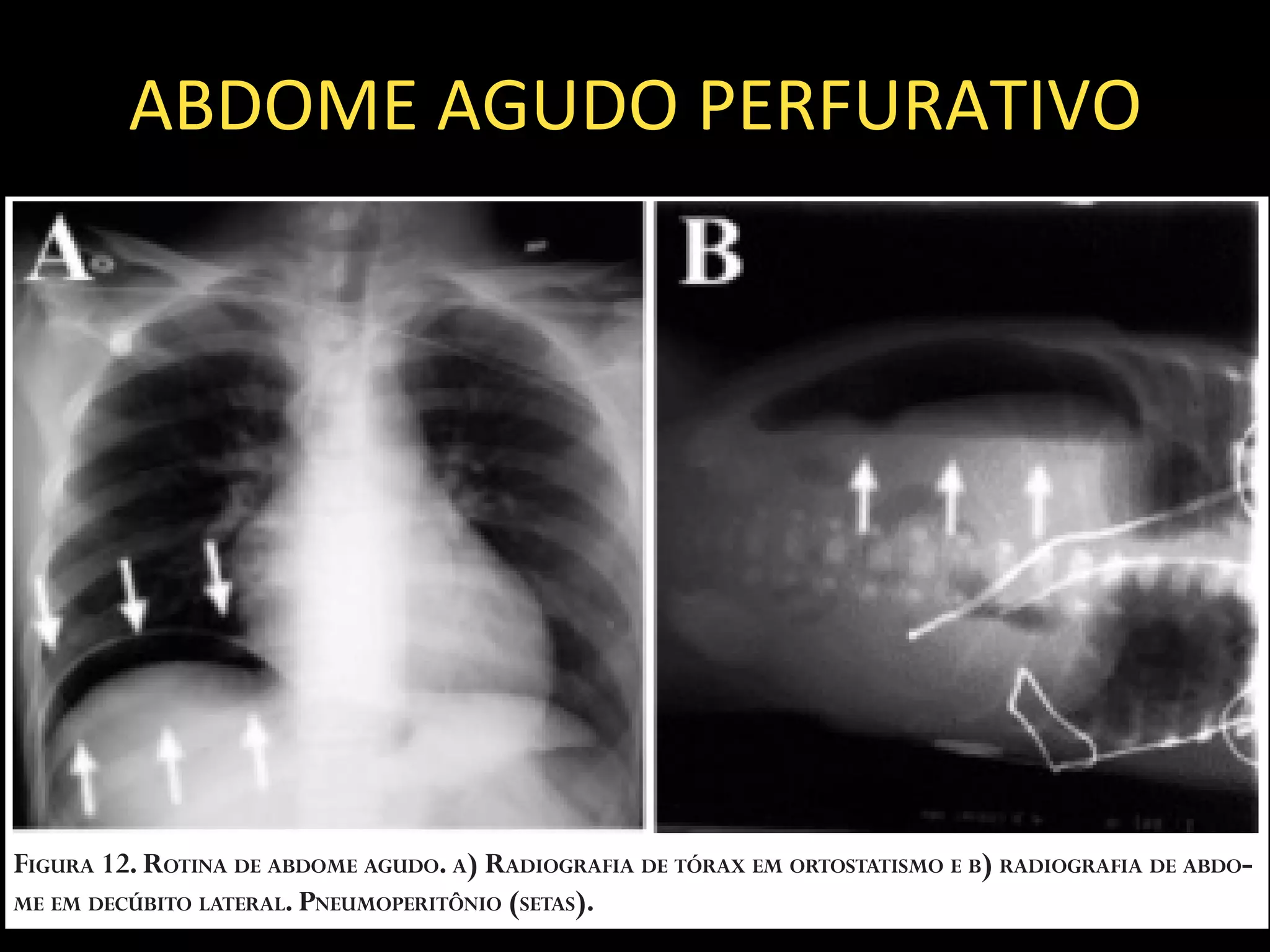 Diagnóstico por imagem no abdome agudo não traumático | PDF