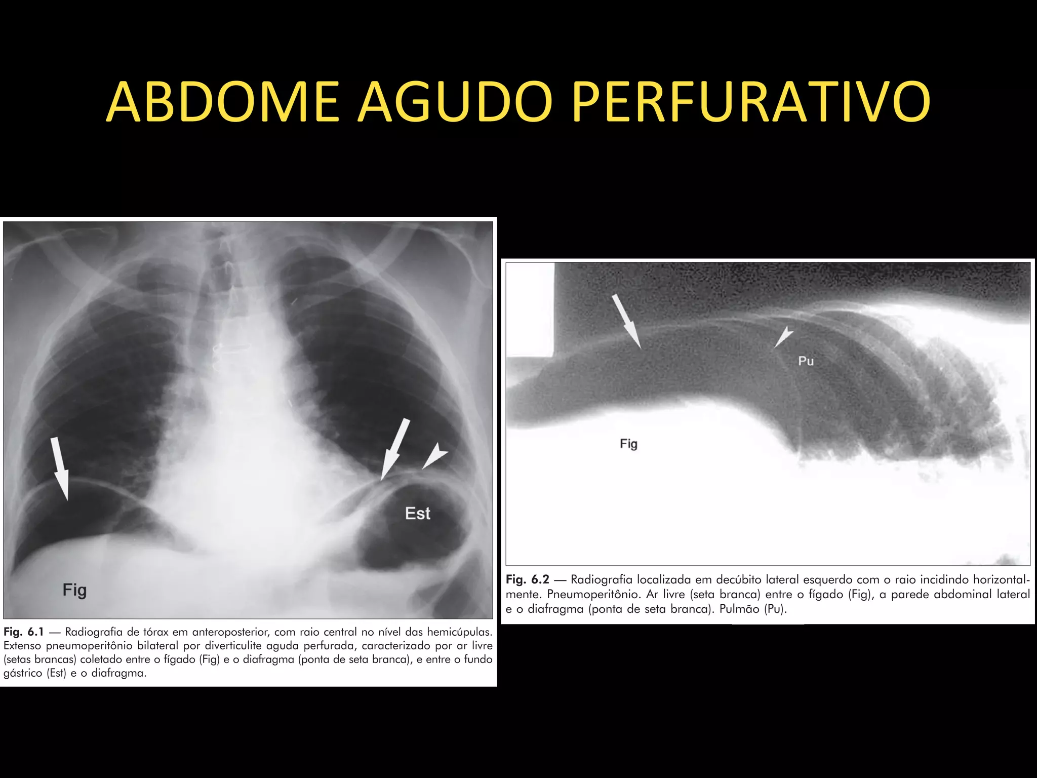 Diagnóstico por imagem no abdome agudo não traumático | PDF
