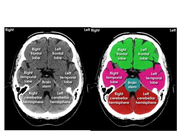 Thuật ngữ giải phẫu hệ thần kinh và ứng dụng CT | PPT