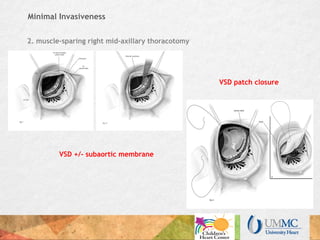 right axillary thoracotomy CHD repair USA grand rounds | PPT