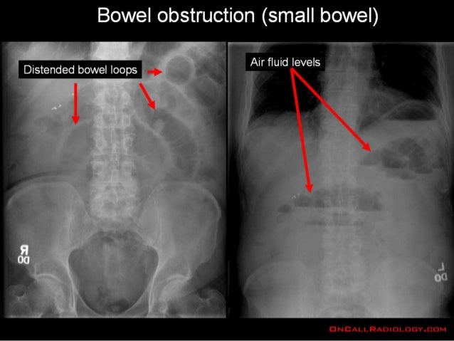 Intestinal obstruction rifhan & saifuddin