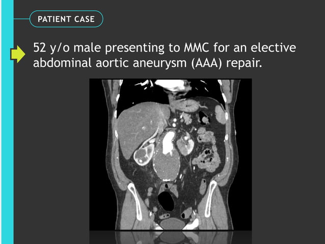Abdominal Aortic Aneurysms | PPTX | Heart and Cardiovascular Diseases ...
