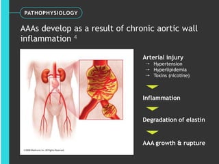 Abdominal Aortic Aneurysms | PPTX
