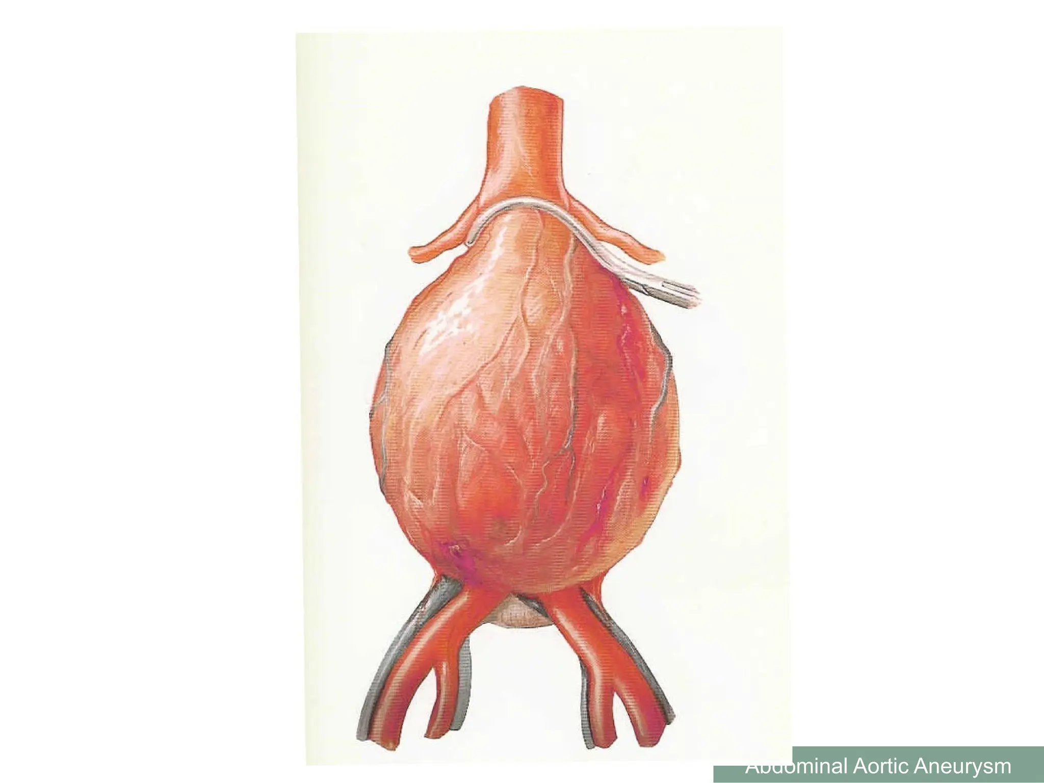 Aortic abdominal aneurysm presentation indonesia | PPTX | Digestive ...