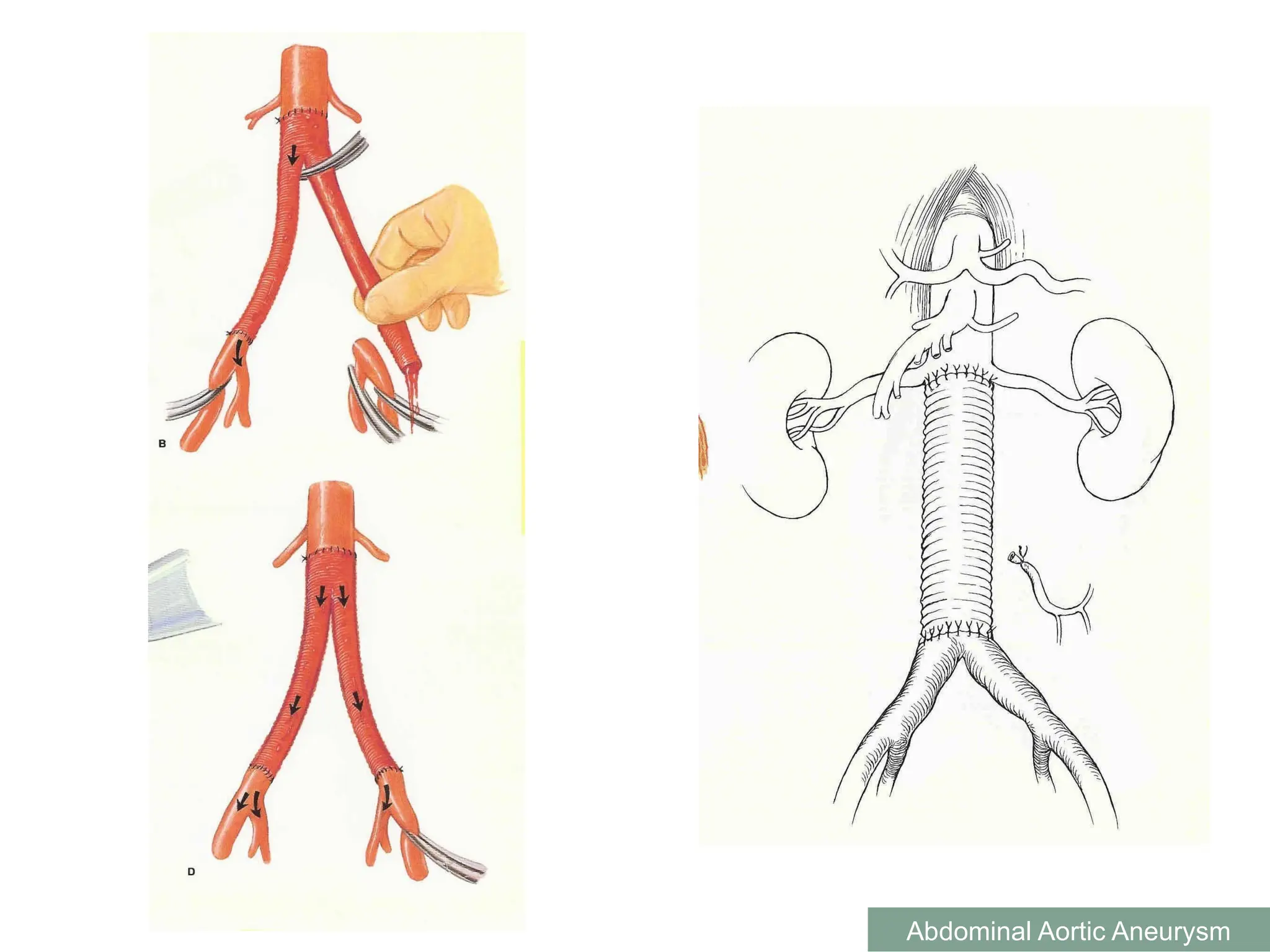 Aortic abdominal aneurysm presentation indonesia | PPTX | Digestive Disorders | Diseases and ...