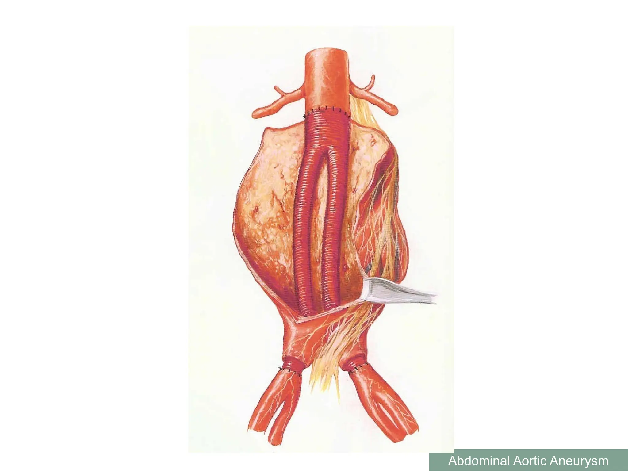 Aortic abdominal aneurysm presentation indonesia | PPTX | Digestive Disorders | Diseases and ...