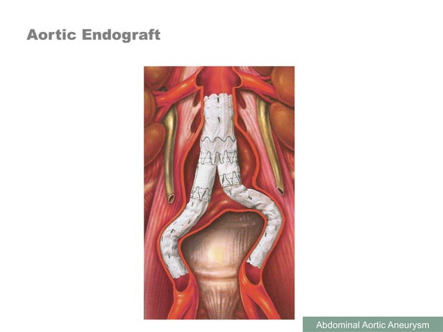 Aortic abdominal aneurysm presentation indonesia | PPTX | Digestive Disorders | Diseases and ...