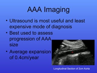 AAA.ppt Abdominal Aortic Aneurysms presentation | PPT