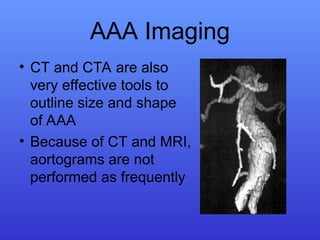 AAA.ppt Abdominal Aortic Aneurysms presentation | PPT