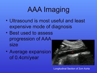 AAA.pptabdominal aortic aneurysms presentation | PPT