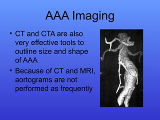 AAA.pptabdominal aortic aneurysms presentation | PPT