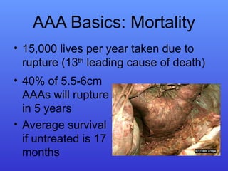 AAA.pptabdominal aortic aneurysms presentation | PPT
