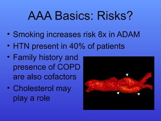 AAA.pptabdominal aortic aneurysms presentation | PPT