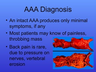 AAA.pptabdominal aortic aneurysms presentation | PPT