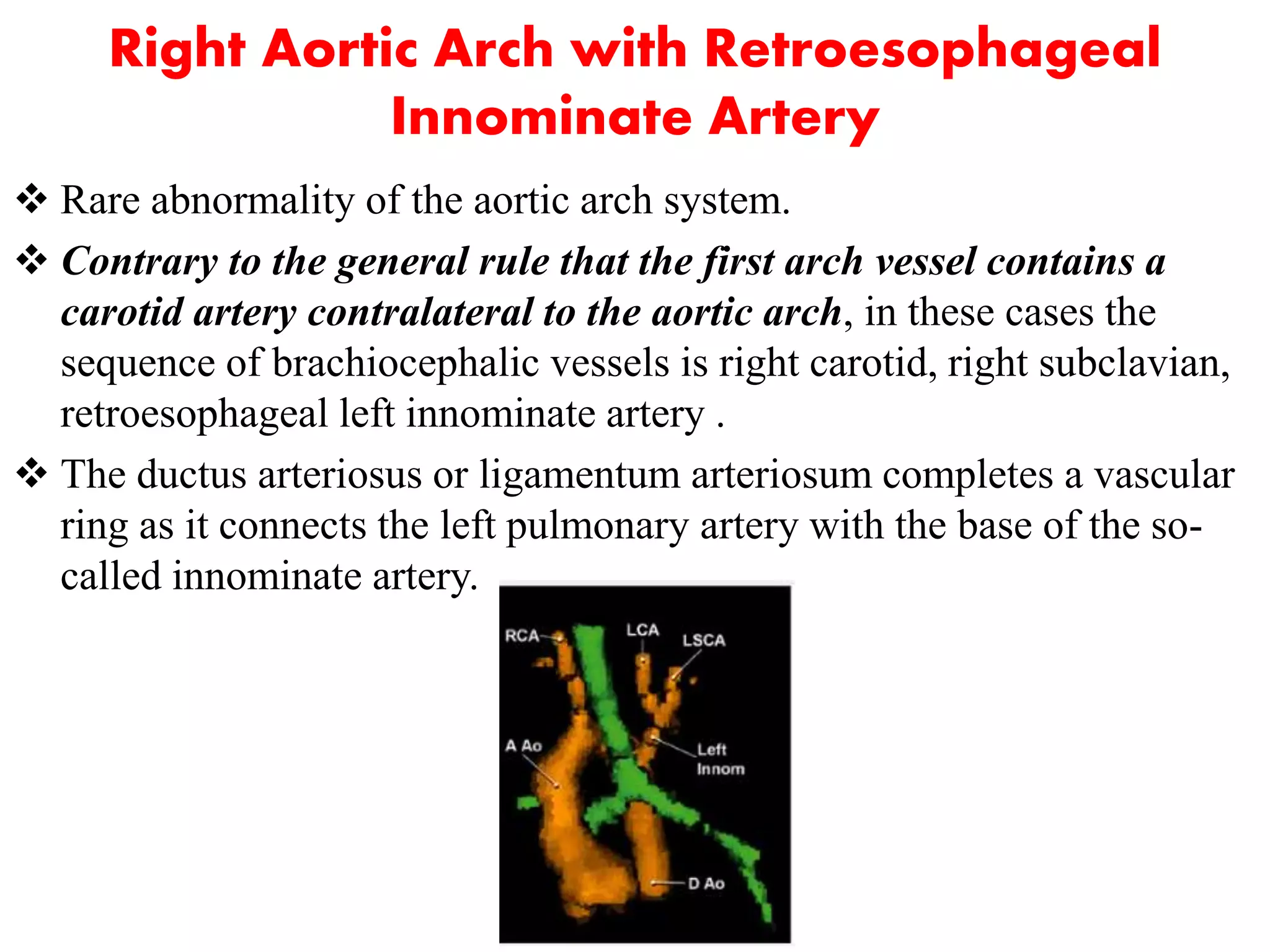 aortic arch anamolies | PPTX