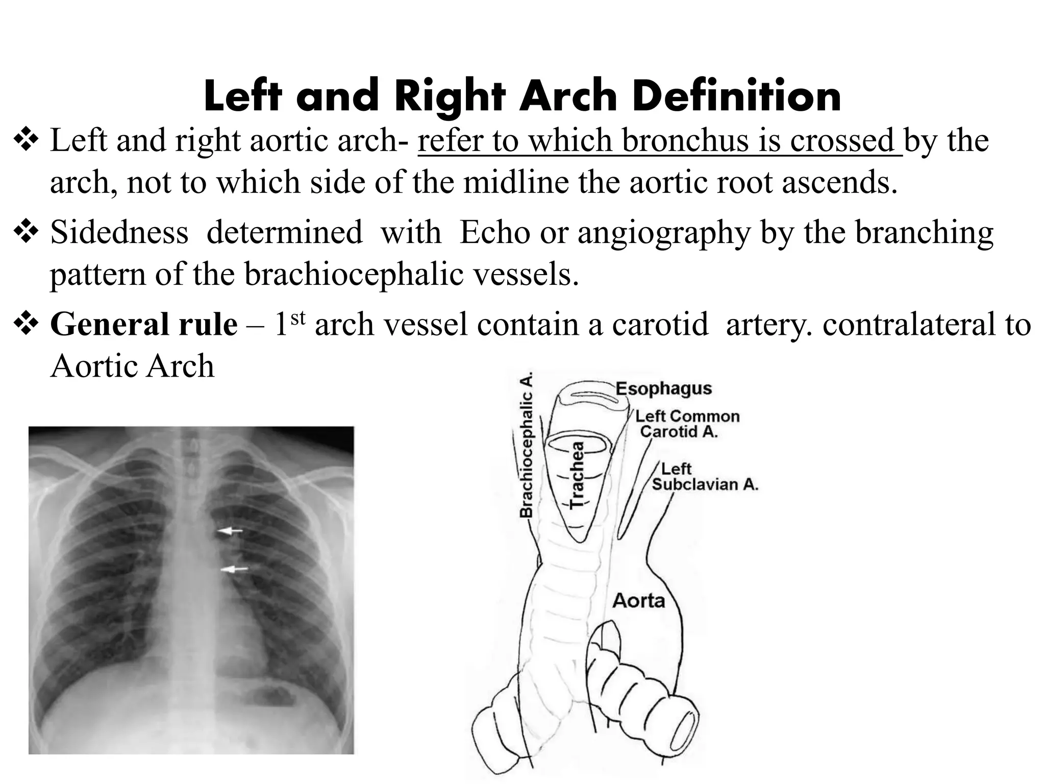 aortic arch anamolies | PPTX