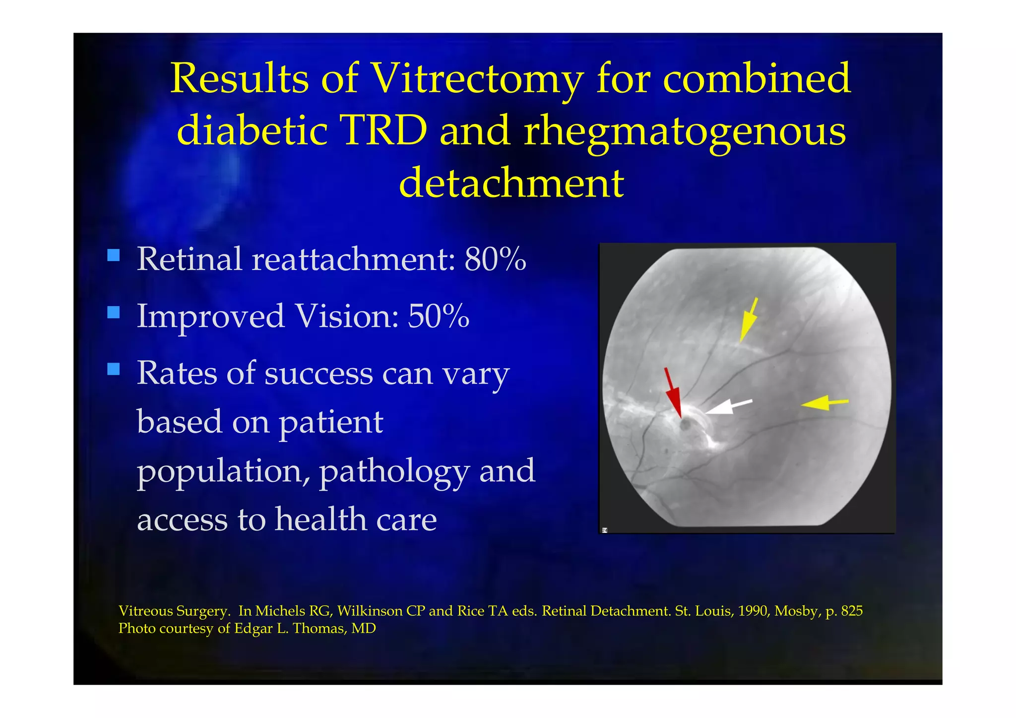 Aaberg jr surgical management for diabetic retinopathy 2014 | PDF