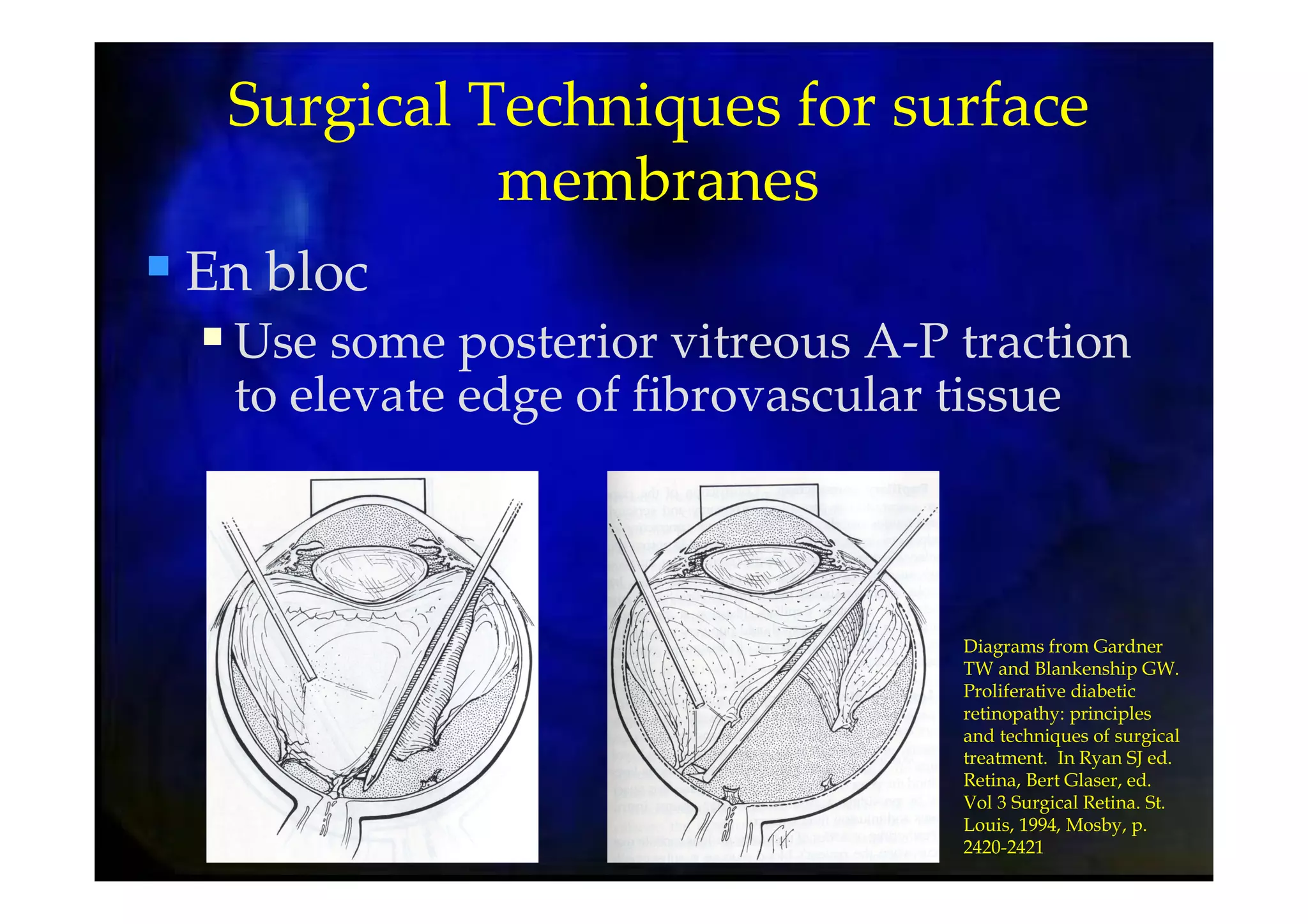 Aaberg jr surgical management for diabetic retinopathy 2014 | PDF
