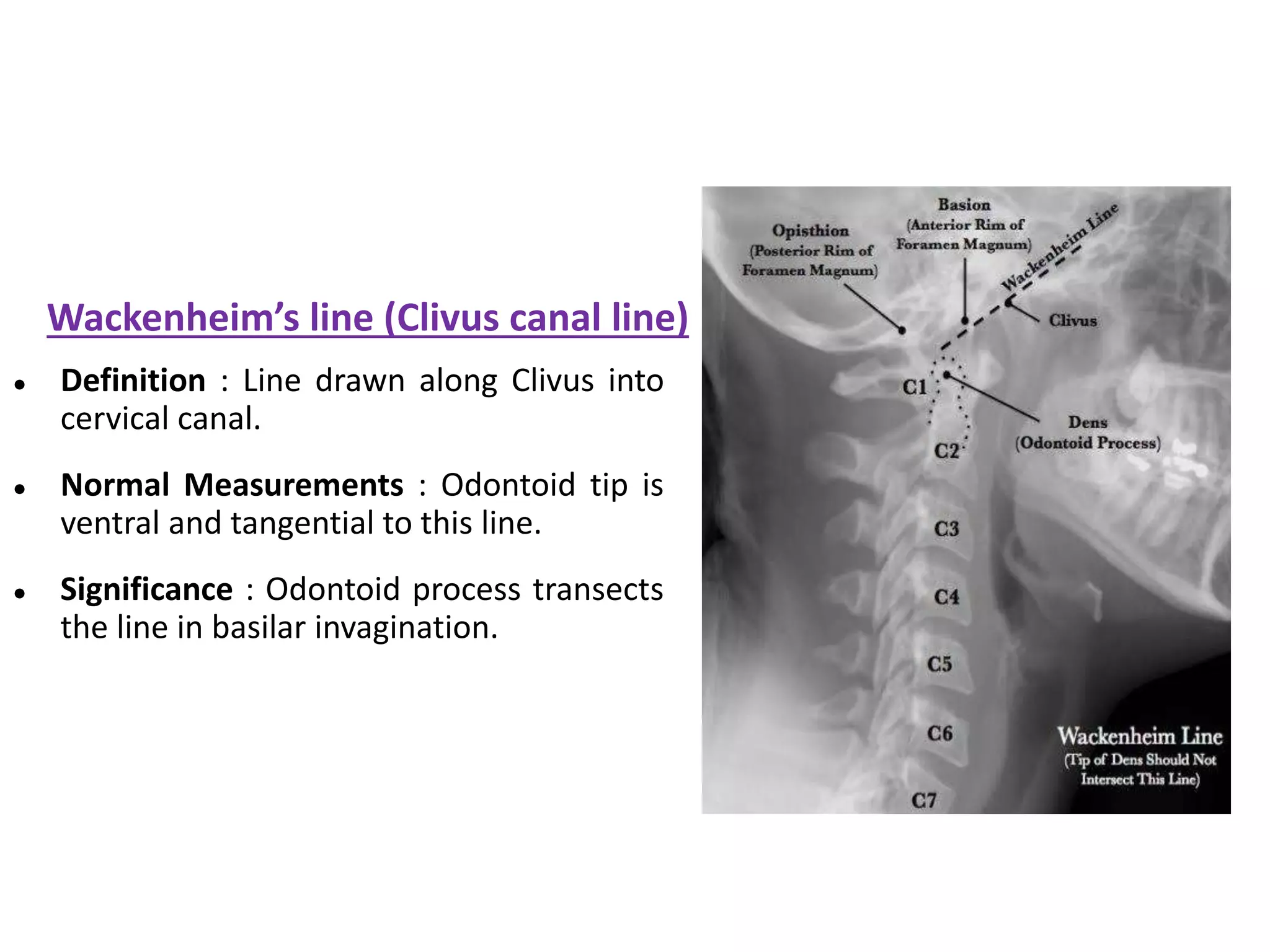 Imaging Cervico-vertebral junction: AAD with BI .pptx