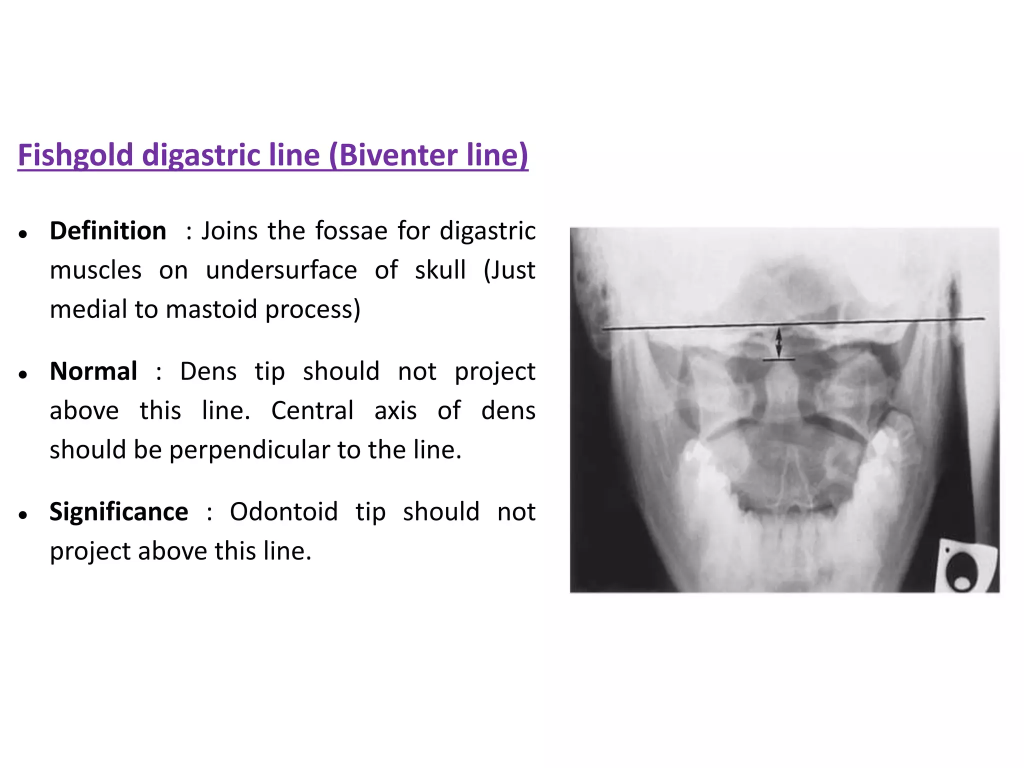 Imaging Cervico-vertebral junction: AAD with BI .pptx